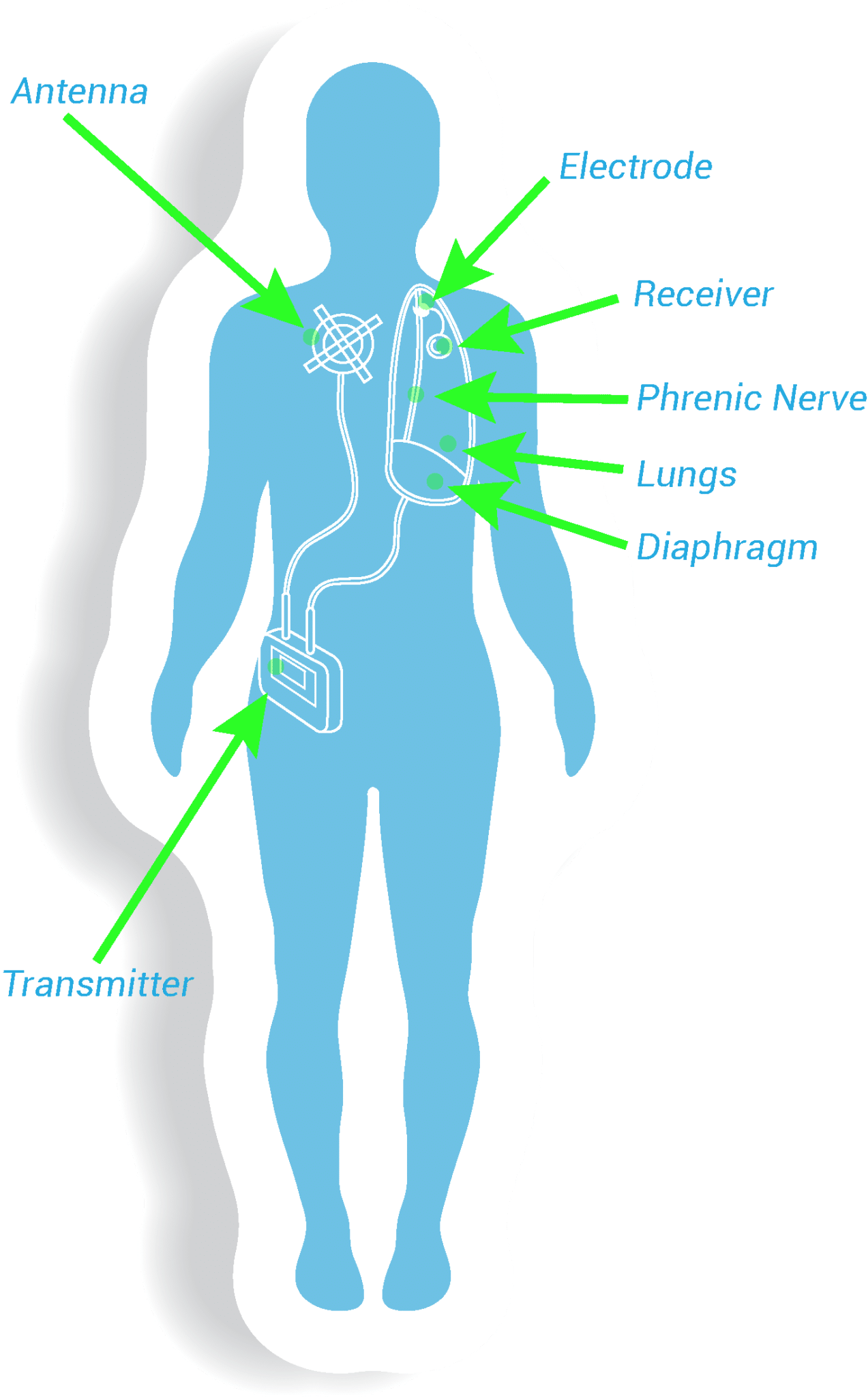 Diaphragm Pacemakers - The Avery Diaphragm Pacing System